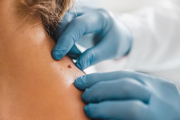 Novel immunotherapy approved for melanoma | News | European ...